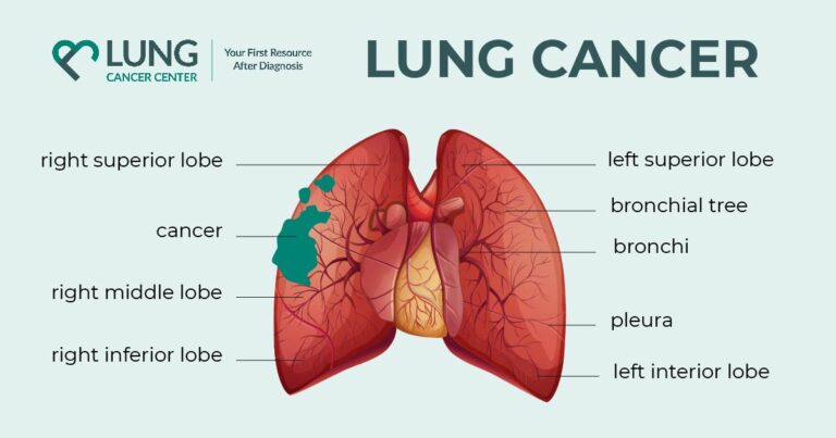 What Is Lung Cancer? - Types, Causes, & Symptoms
