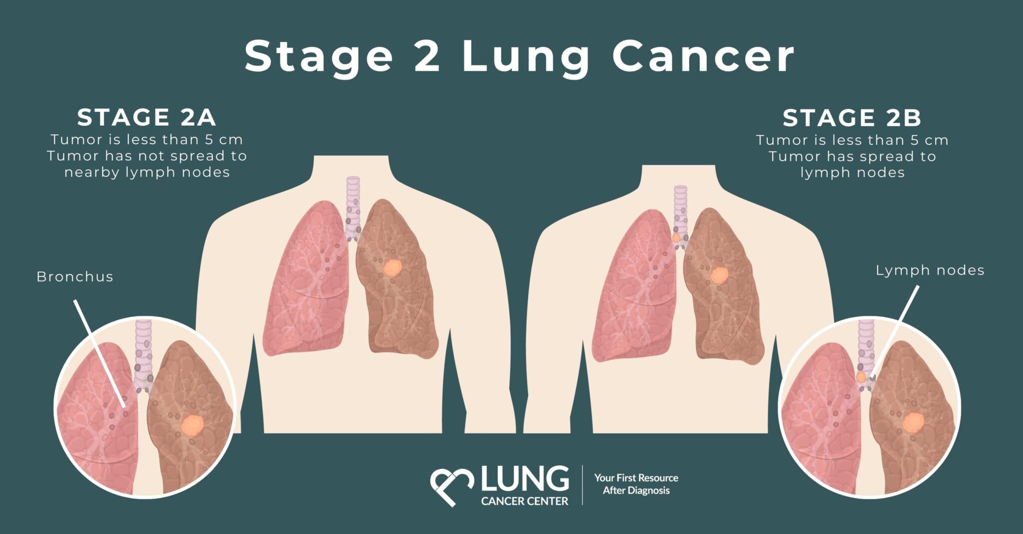 Stage II Lung Cancer | Prognosis, Survival Rates & Treatment