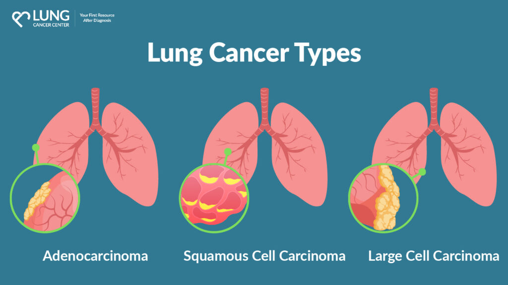 Different Types of Lung Cancer and Treatment